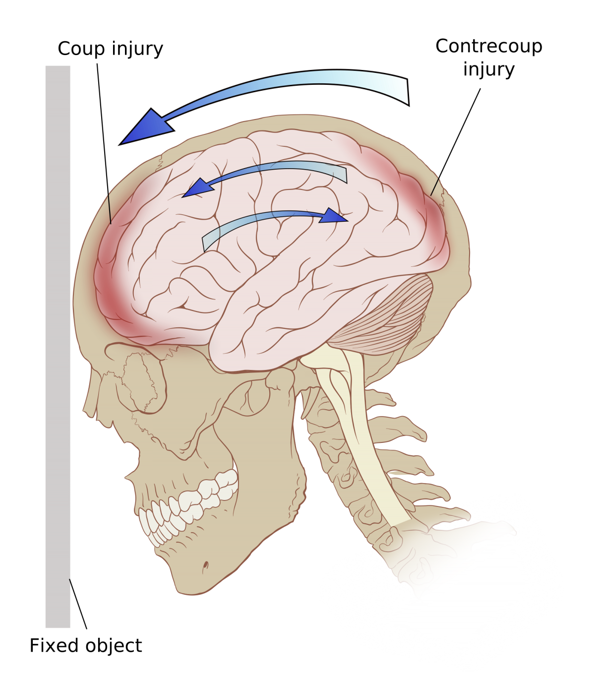 Le traumatisme crânien - Avocat indemnisation de victimes